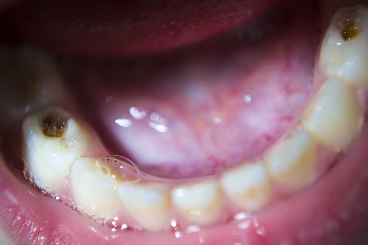 Tooth Pain: Causes, Prevention And Treatment Options