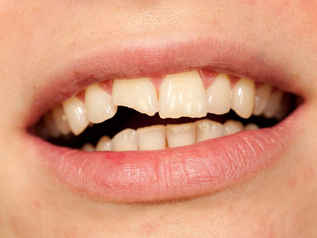 What To Do About A Broken Tooth » 7 Fractured Tooth Risks