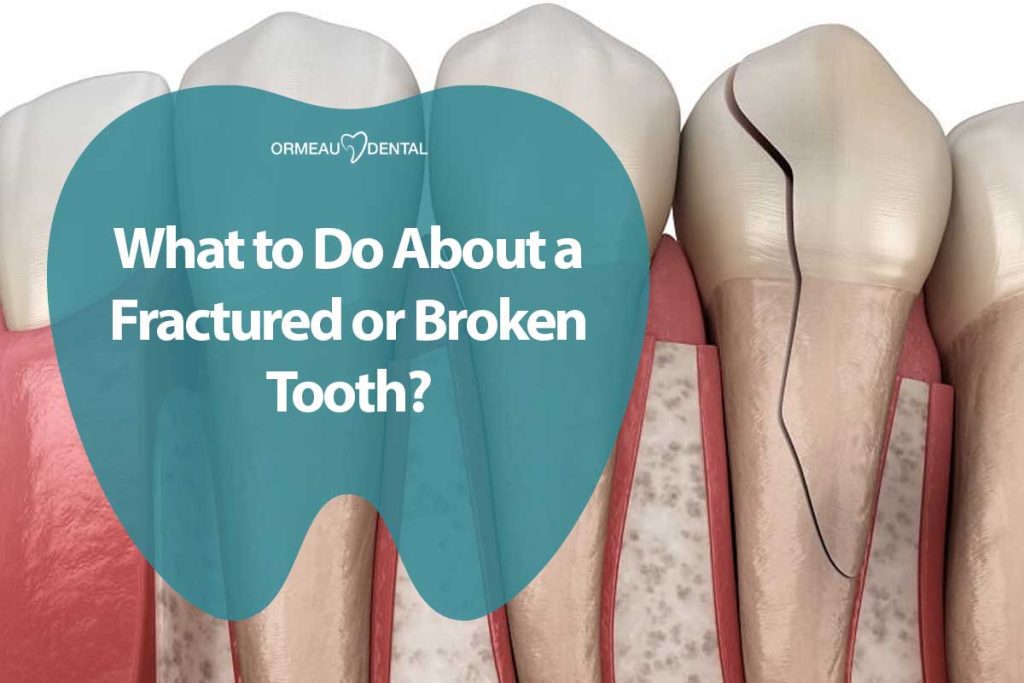What To Do About A Broken Tooth » 7 Fractured Tooth Risks